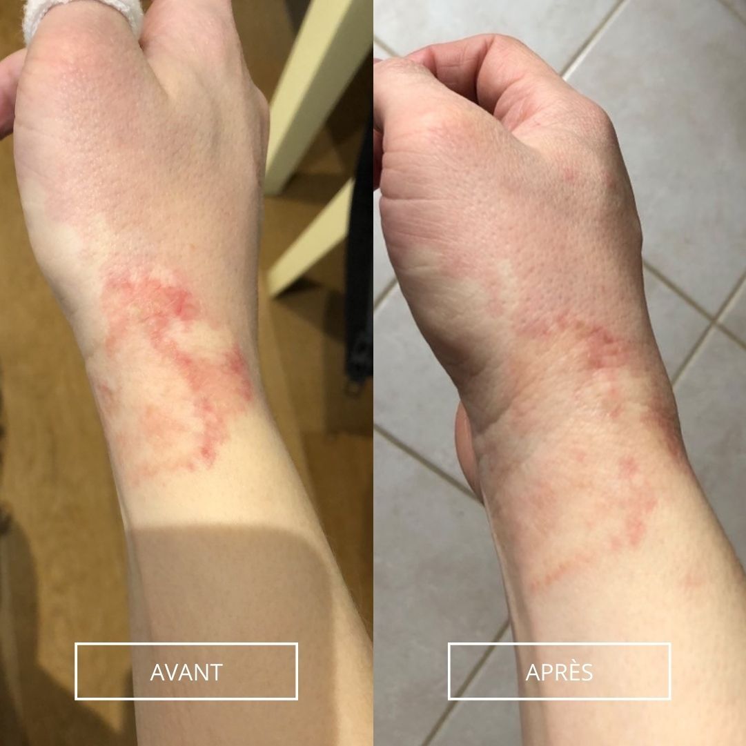 Soin eczéma | Crème, Nettoyant, Sérum | 100/100 Yuka