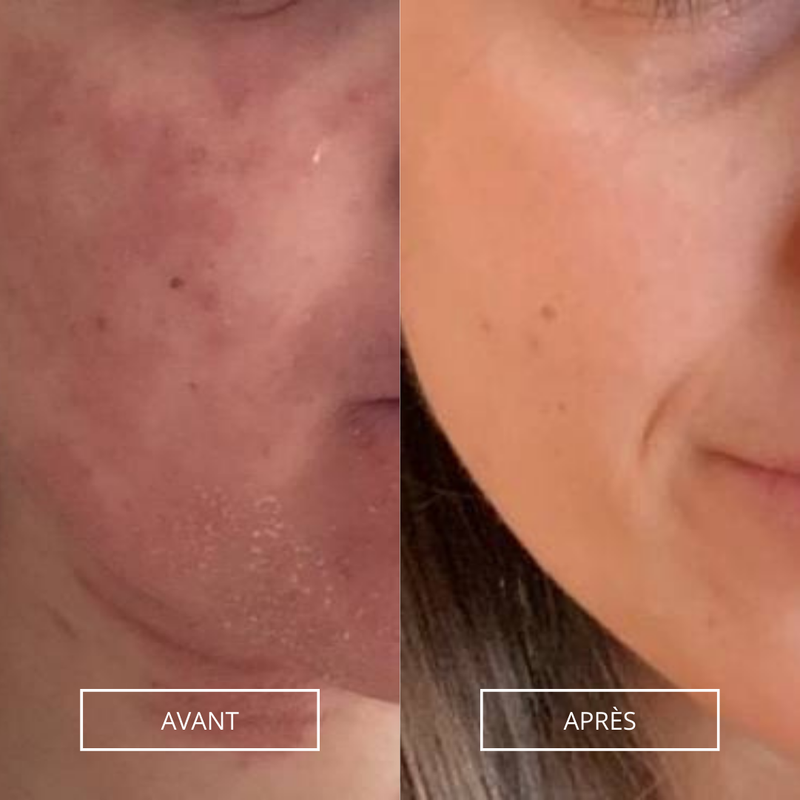 Soin eczéma | Crème, Nettoyant, Sérum | 100/100 Yuka